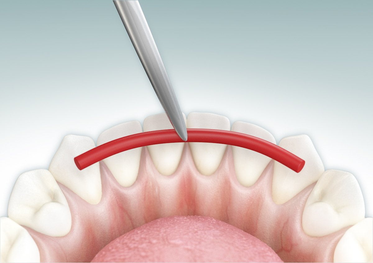 Splintaggio denti in due parole, ma occorre attenzione!